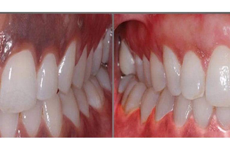 Gum De pigmentation - Arka Dental Clinic